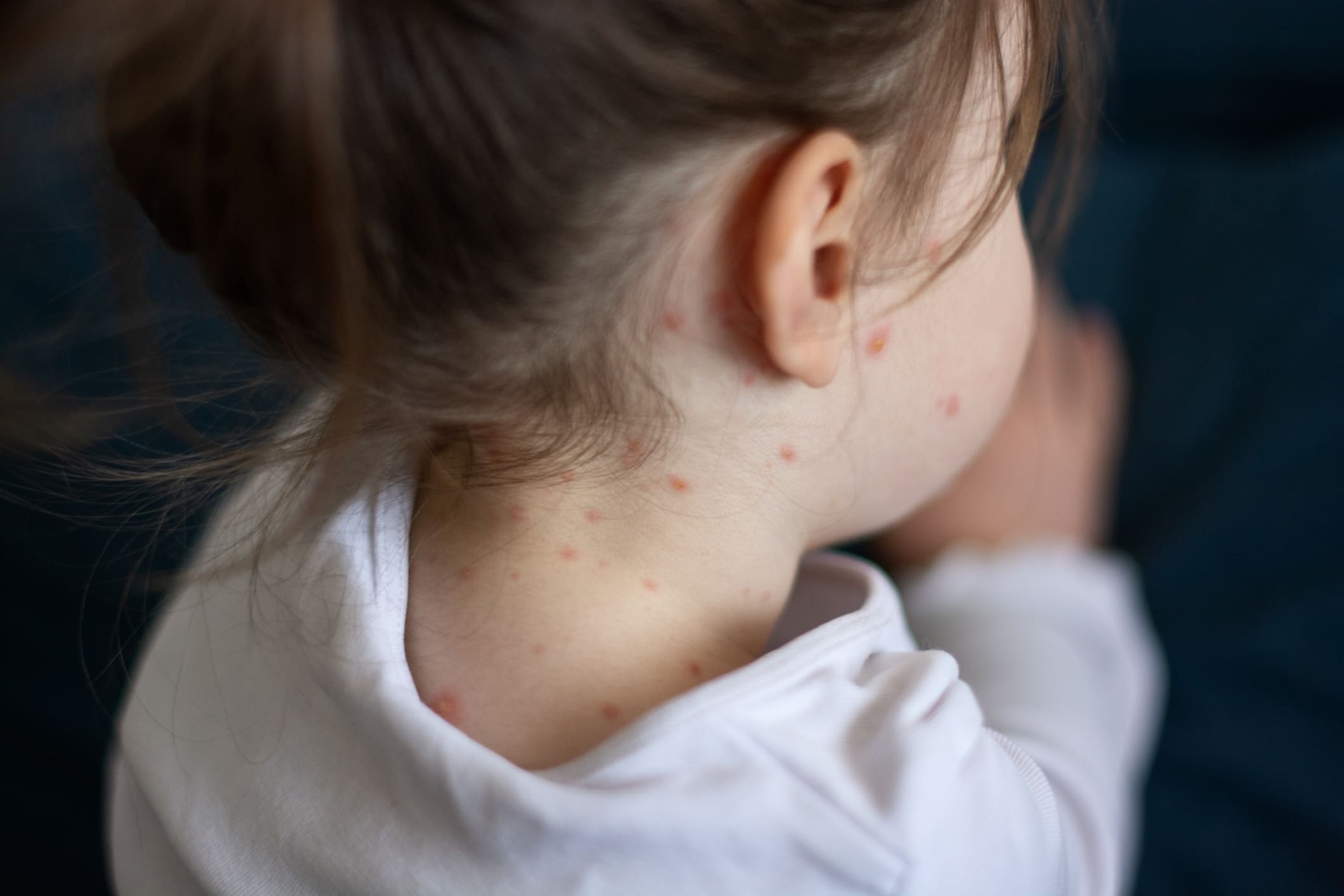 Measles: Parents urged to ensure their children are protected > Glos ...